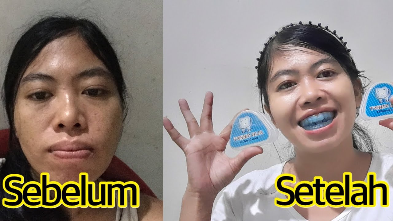 Gigi rapi tanpa behel!Cara ampuh mengatasi gigi boneng|cegah mulai ...