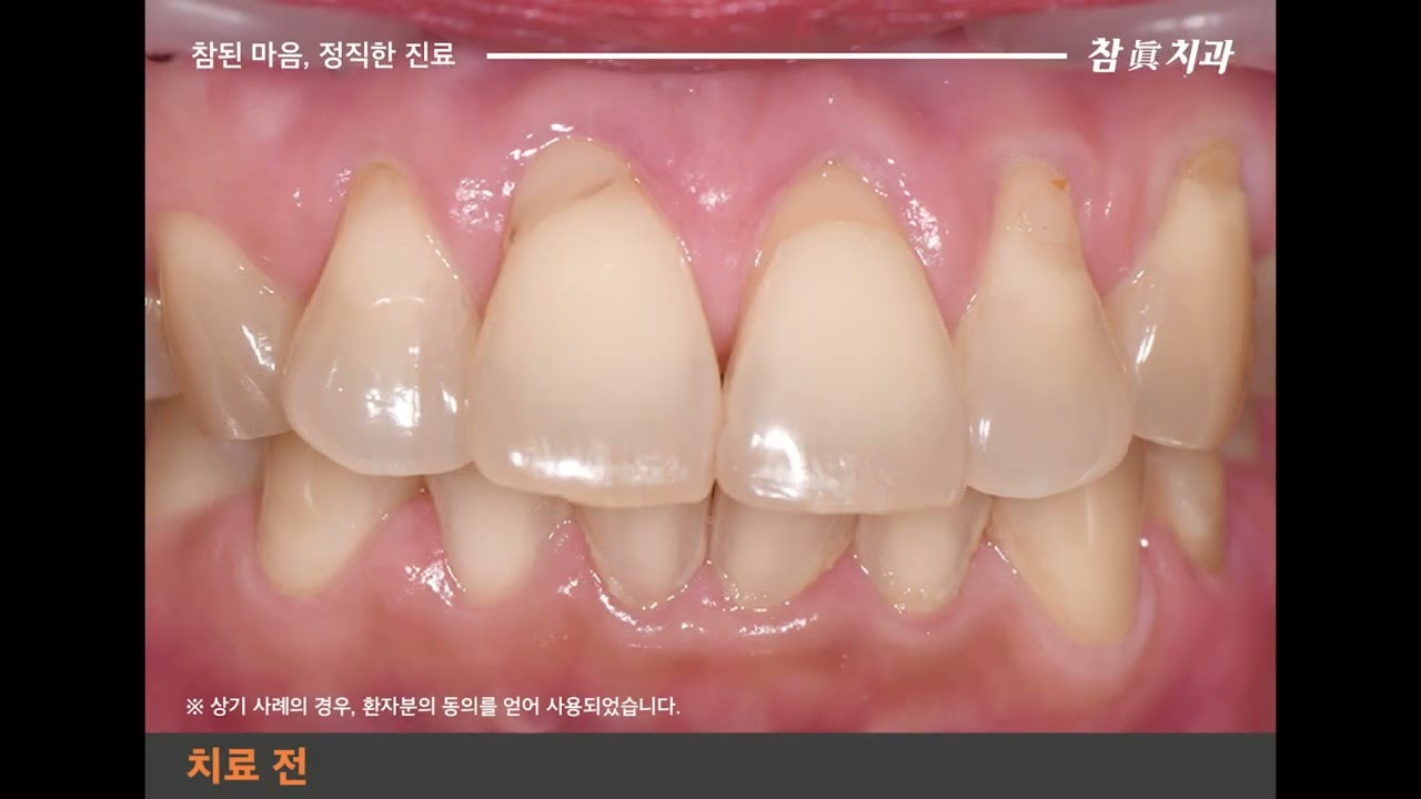 앞니 임플란트 증례 잇몸성형증례 Youtube