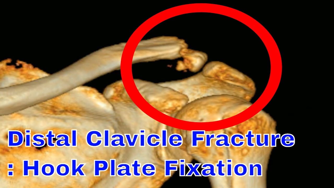 Fractured Distal Clavicle? Surgical Fixation with Hook Plate: Step-by ...
