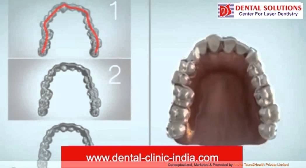 Clear Path Aligners India | Affordable Orthodontist Bangalore - YouTube