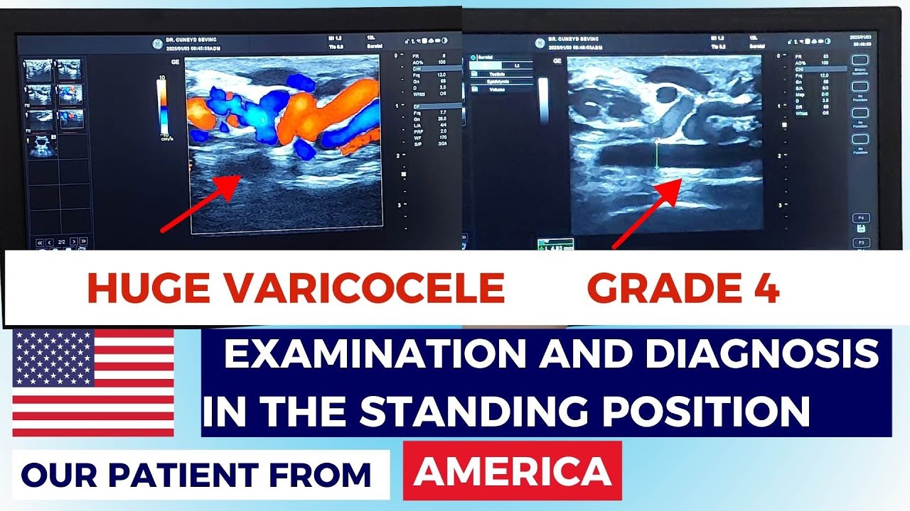 Examination and Diagnosis in the Standing Position - Varicocele Grade 4 ...