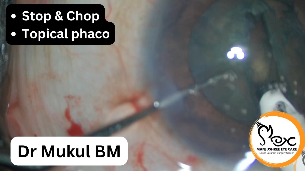 Stop and chop - Topical Phaco - YouTube
