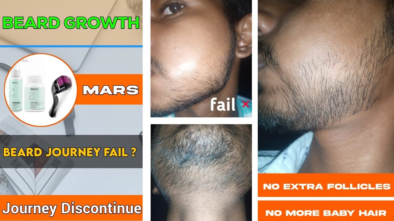 BEARD GROWTH ! दाढ़ी उगाने के लिए minoxidil लगाना बंद कर दिया ! Beard ...