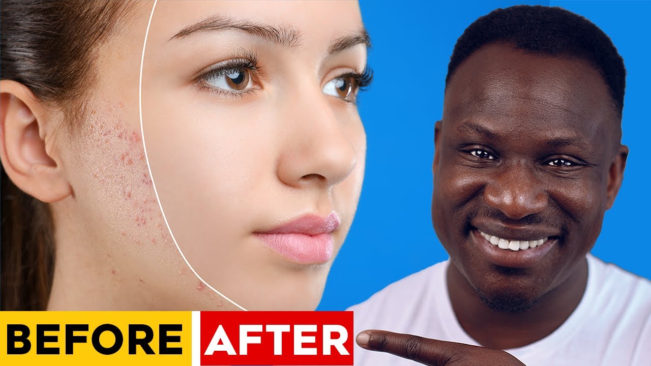 How To Get Clear Skin, Remove Spots, Large Blackheads, Acne & Dark ...