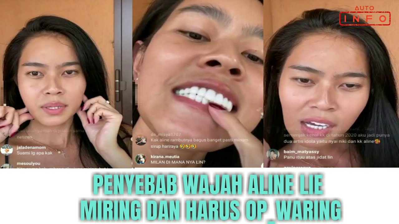 IG Live : Penyebab Wajah ALINE LIE Alias WARING Miring (Tmn Gebby Vesta ...