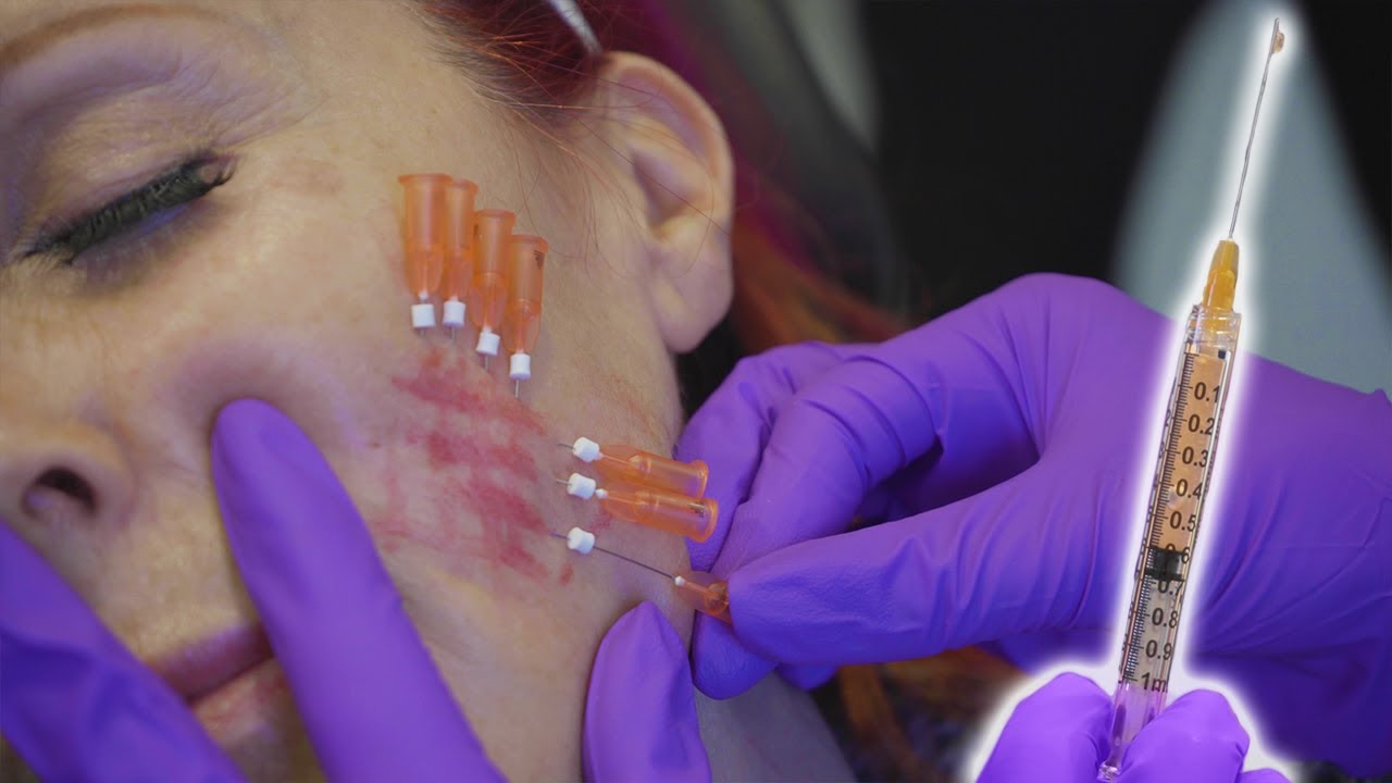 PDO Thread Lift and Revanesse Versa Enhanced with Platelet-Rich Fibrin ...