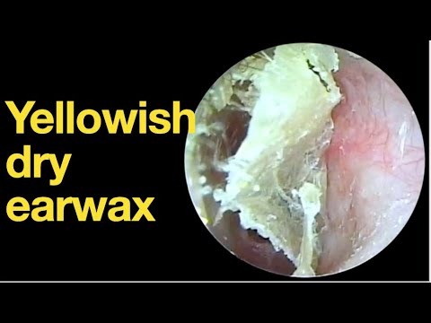 Yellowish dry earwax |ear wax removal | ear cleaning | ASMR ...