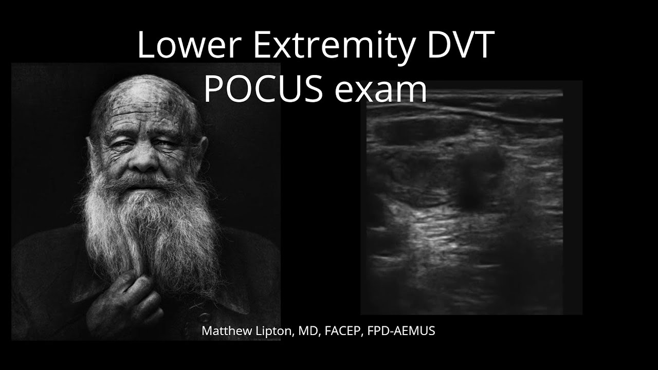 5 minute POCUS exam to diagnose a lower extremity DVT - YouTube