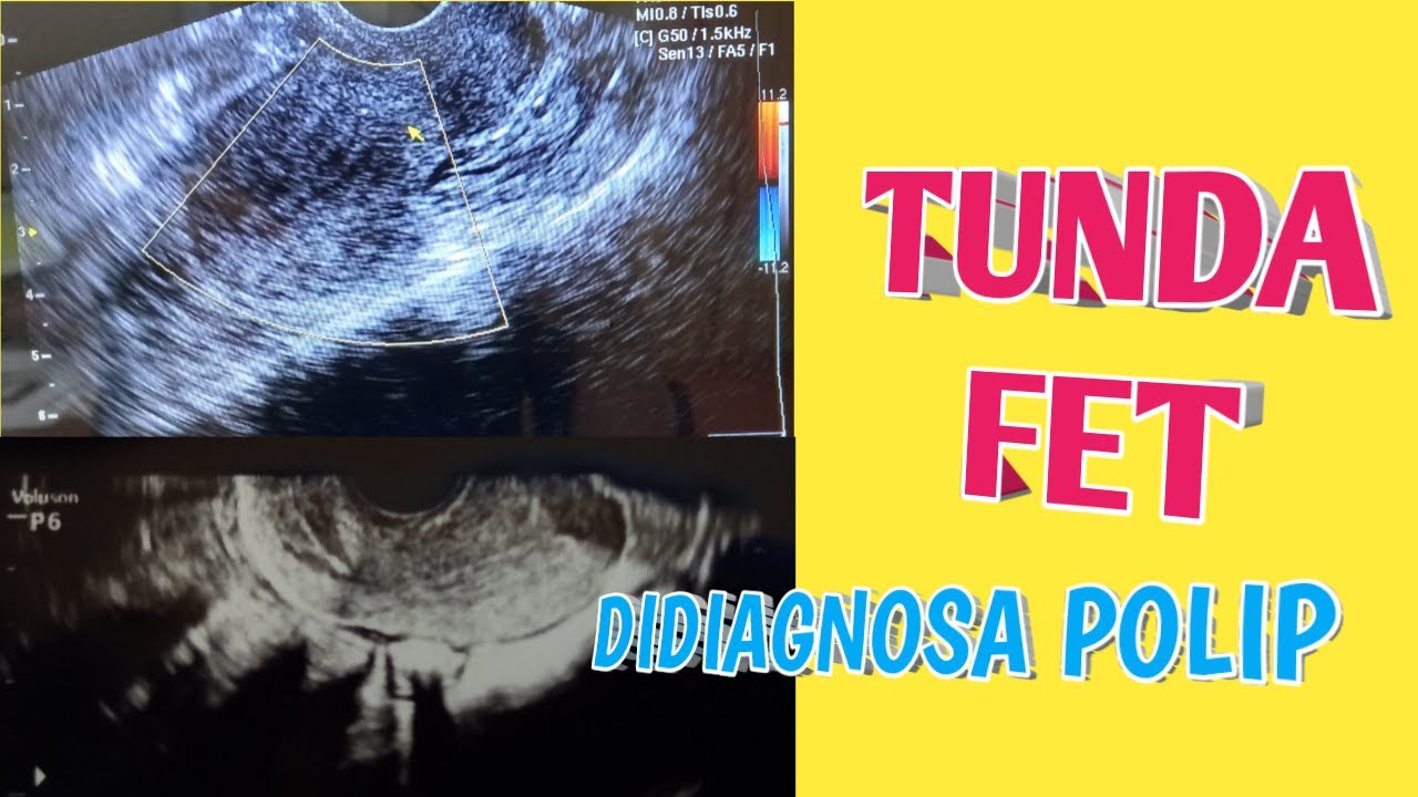 Gagal IVF, Tunda FET (freezing embryo transfer), didiagnosis polip ...