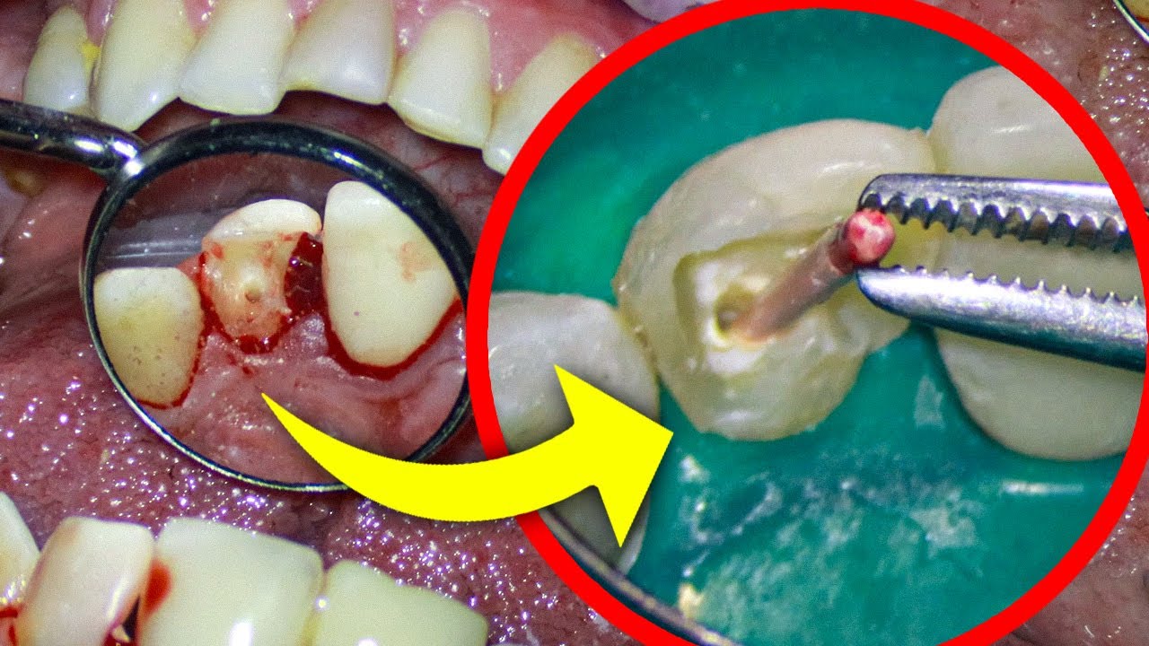 Root Canal Filling and Nerve Removal - YouTube