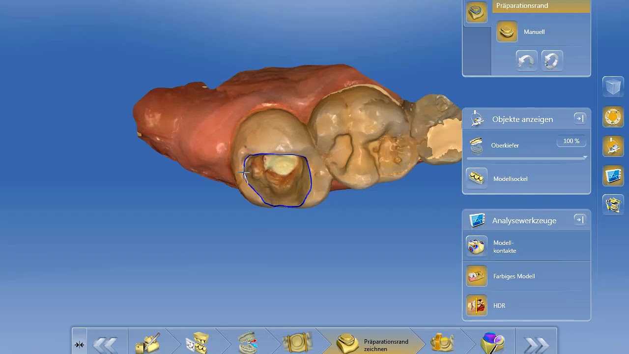 Inlay with CEREC - YouTube