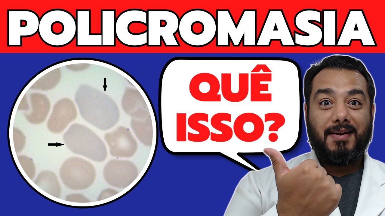 Policromasia: o que pode indicar no seu exame de sangue (hemograma ...