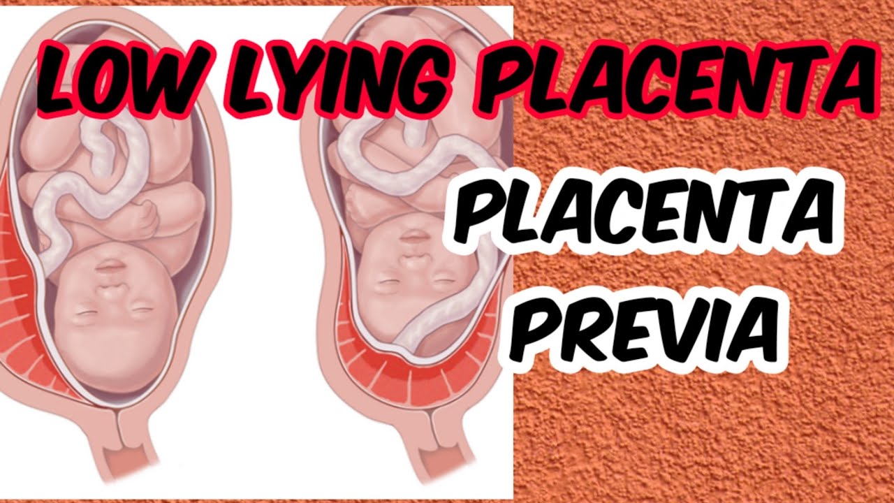 Placenta previa/low lying placenta|malayalam|Kukku's media|aleena - YouTube