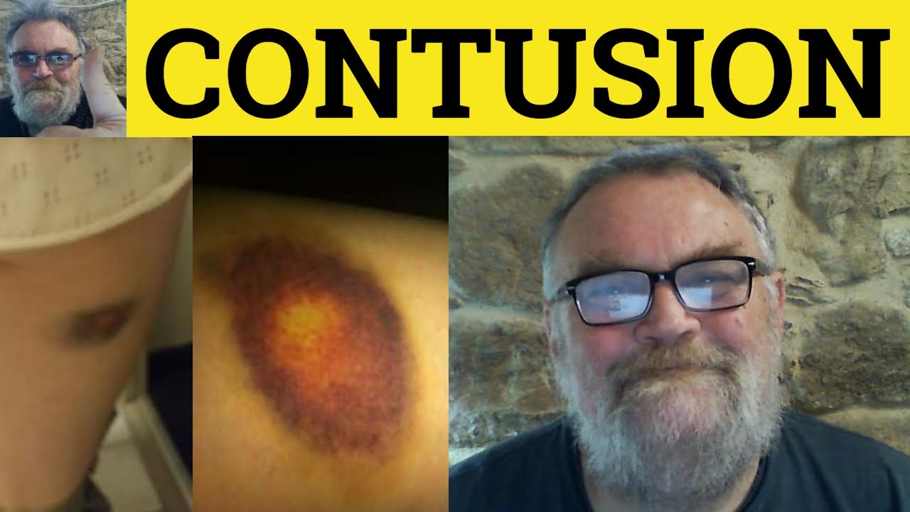 🔵Contusion Meaning - Contusions Examples - Contusion Definition - GRE ...