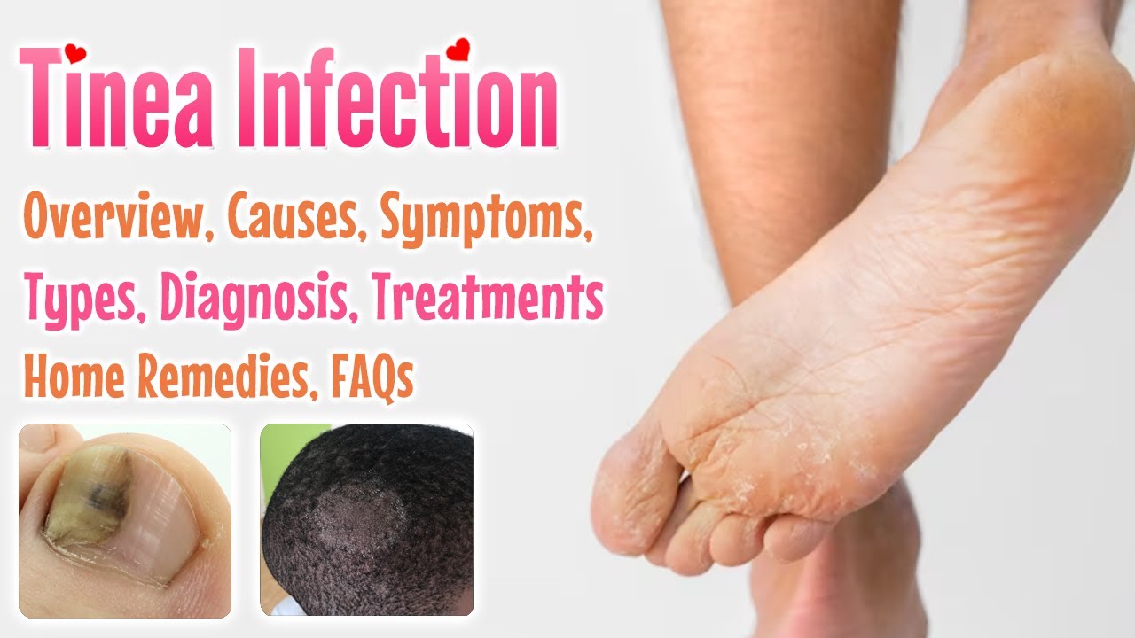 Tinea overview, causes, sign and symptoms, diagnosis, treatment, home ...