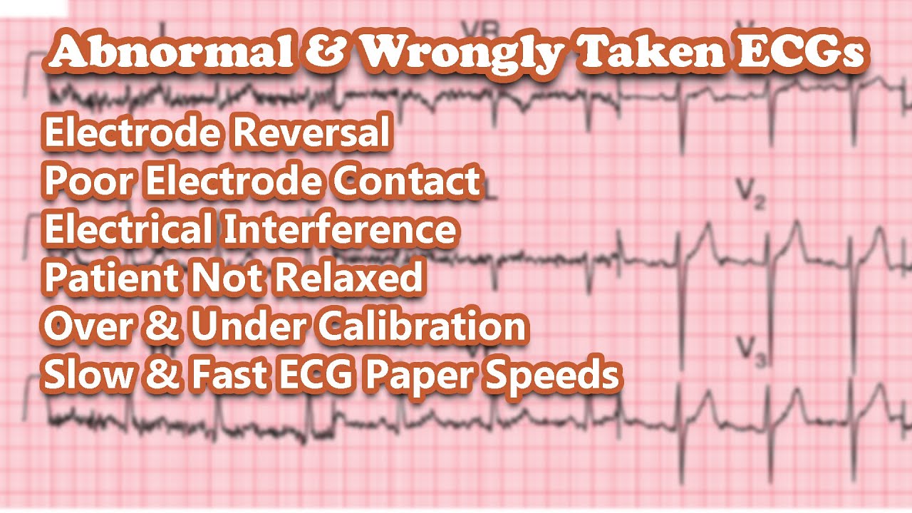 Abnormal & Wrongly Recorded ECGs | Electrode Reversal | Poor Contact ...