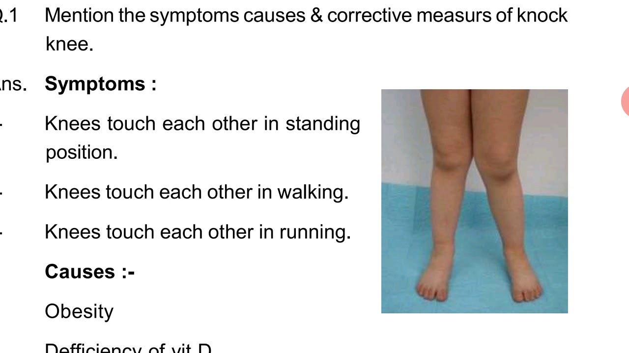 Postural deformity knock knee - YouTube