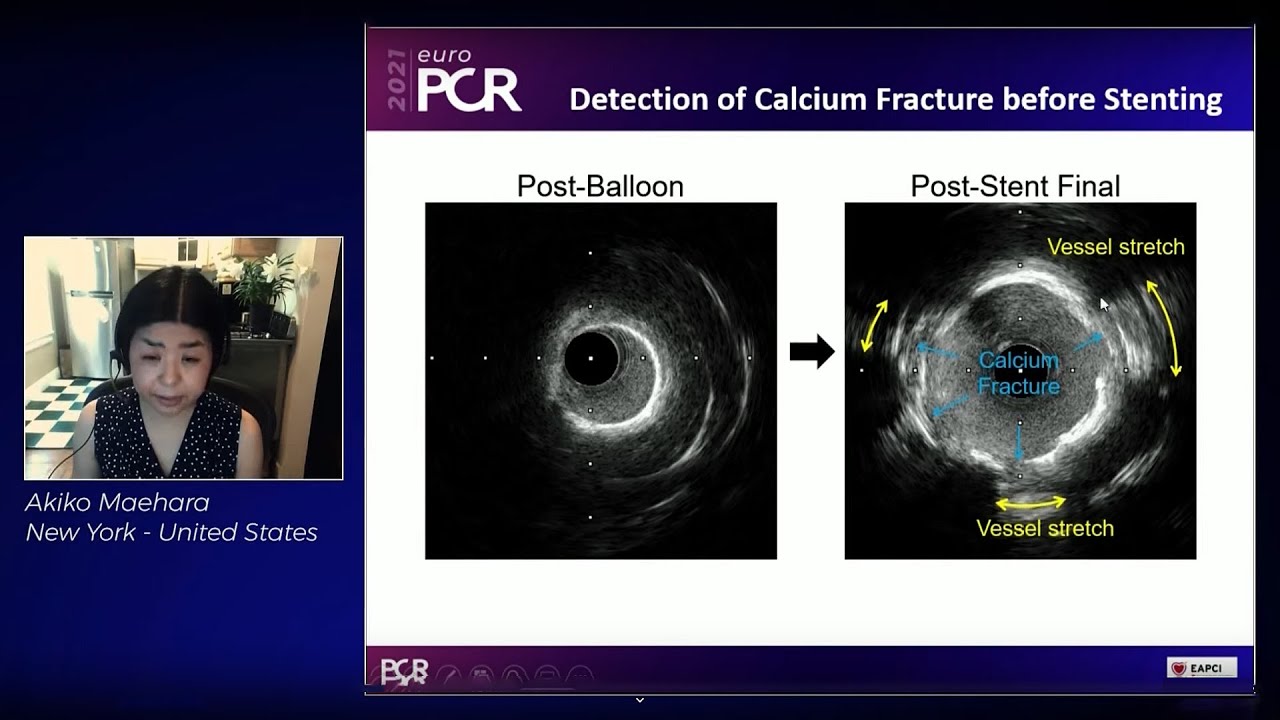 Complex PCI in coronary calcified lesions, the right tools and ...