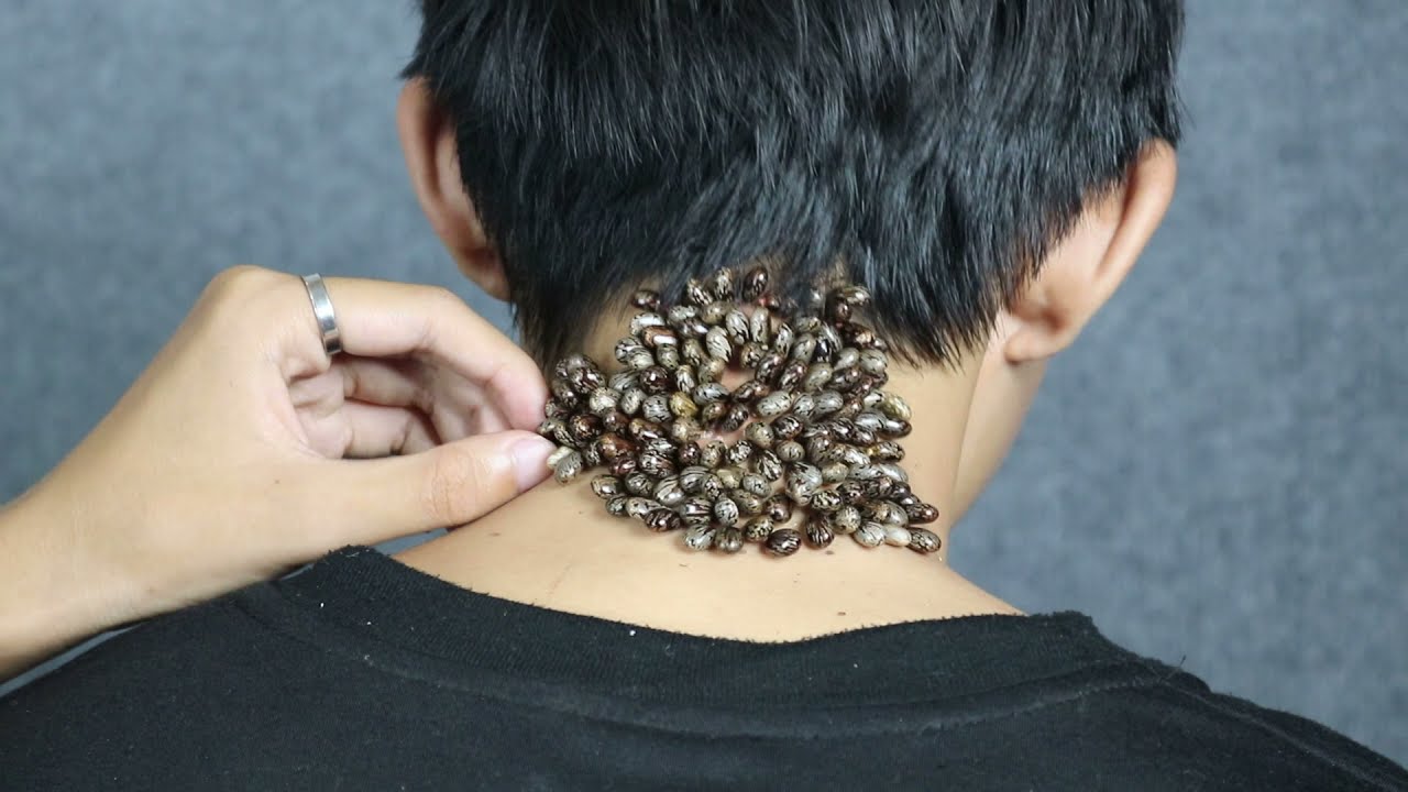 remove the tick from the nape of the neck and treat the wound caused by ...