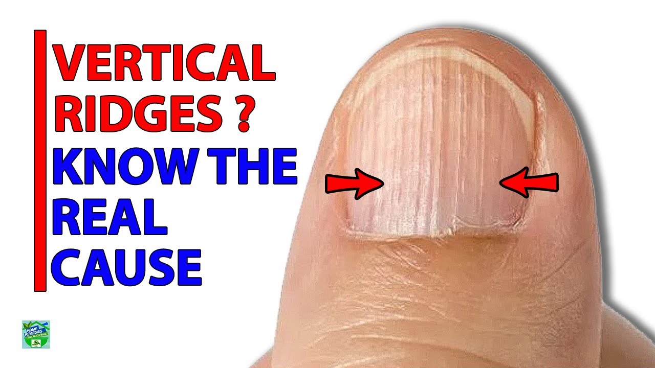 Did You Know The REAL Cause of VERTICAL RIDGES On Your Nails ? - YouTube