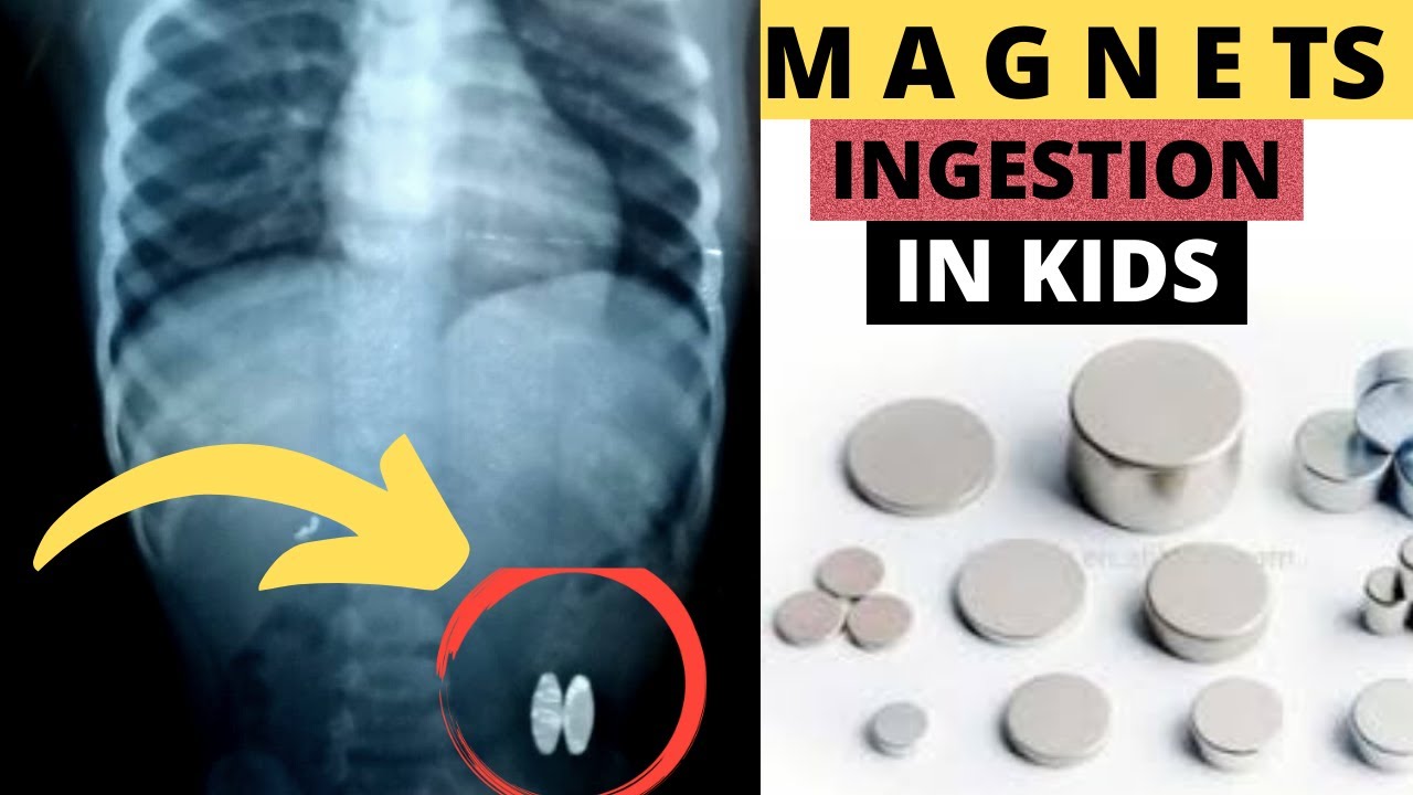 Accidental Magnet Ingestion in Children #accidental #posoning - YouTube