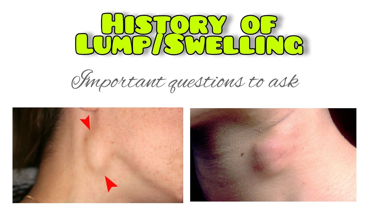 How to take history of lump | VERY IMPORTANT - YouTube