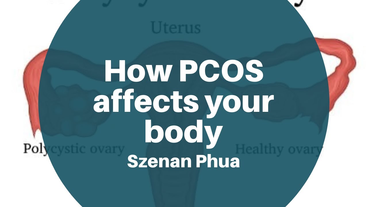 How PCOS affects your body-Dinsdale-Hamilton-Cambridge-Auckland ...