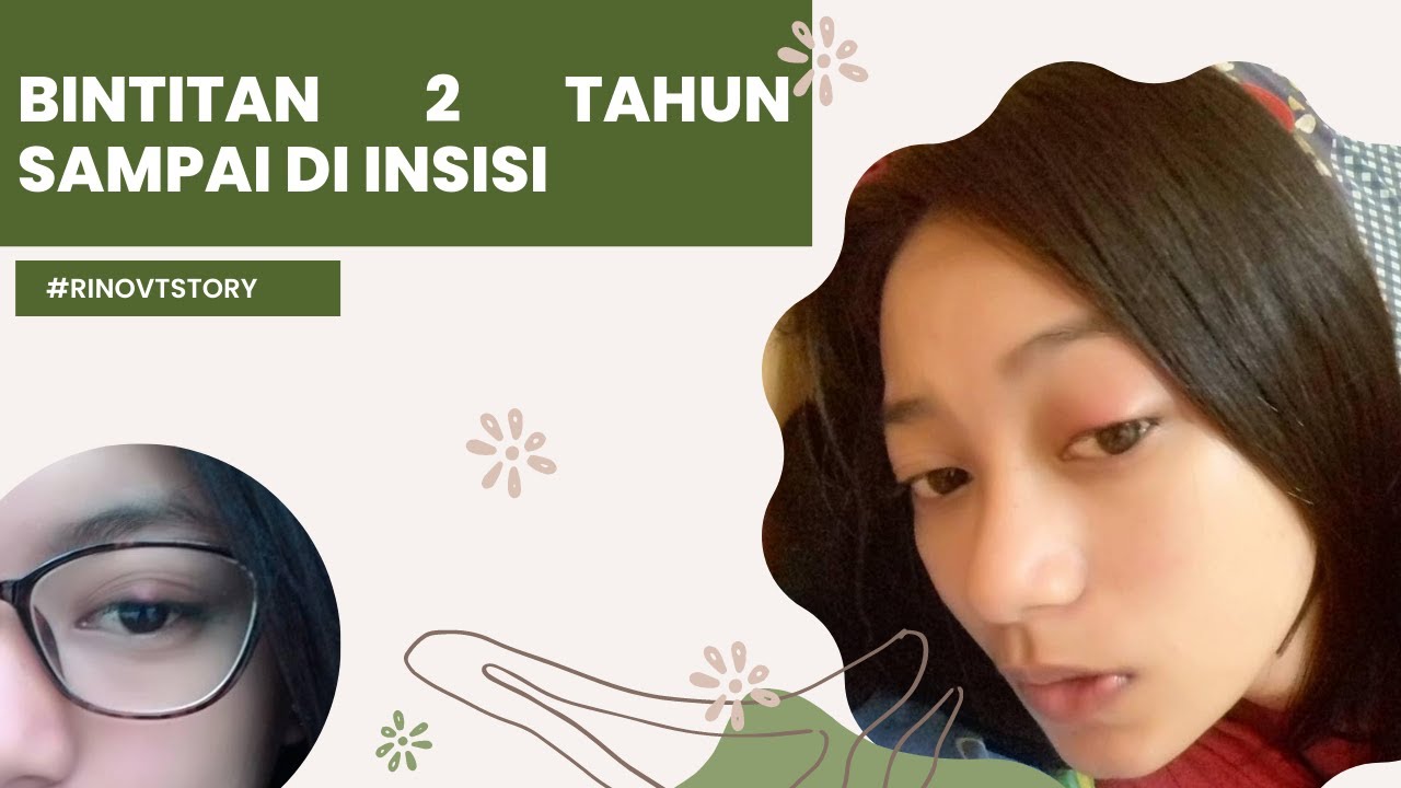 PENGALAMAN CARA MENGHILANGKAN BINTITAN KALAZION DENGAN INSISI OPERASI ...