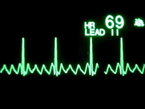Atrial Flutter - YouTube