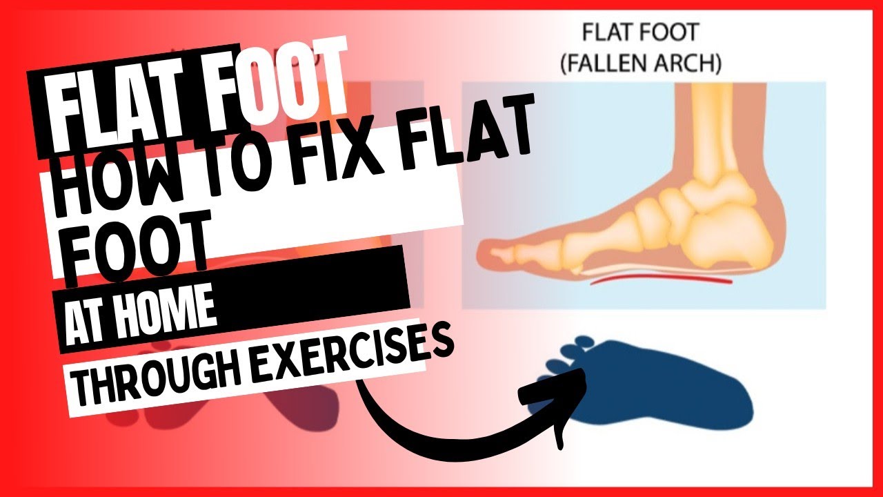Best exercises for flat foot/Physiotherapy treatment #physiotherapy# ...