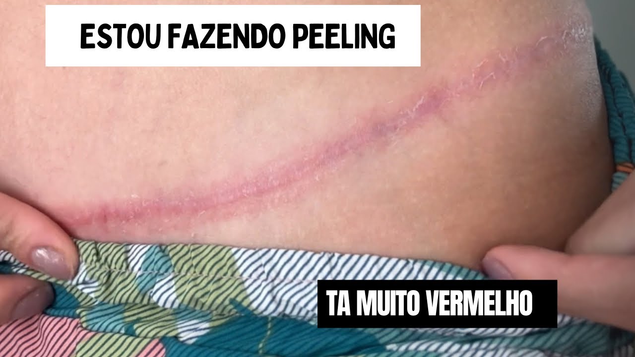 CICATRIZES COM 3 MESES PÓS ABDOMINOPLASTIA, LIPO E MASTOPEXIA - YouTube