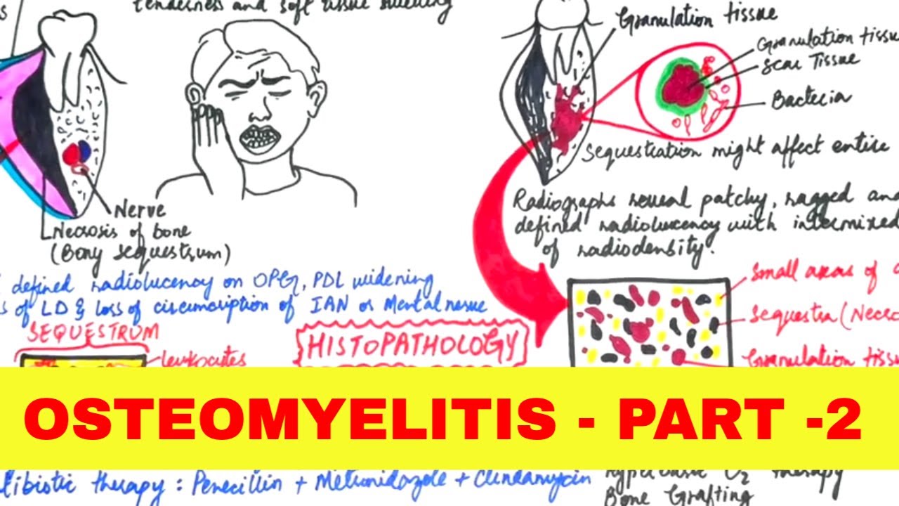 Osteomyelitis - Causes, pathophysiology, Clinical Features, and ...