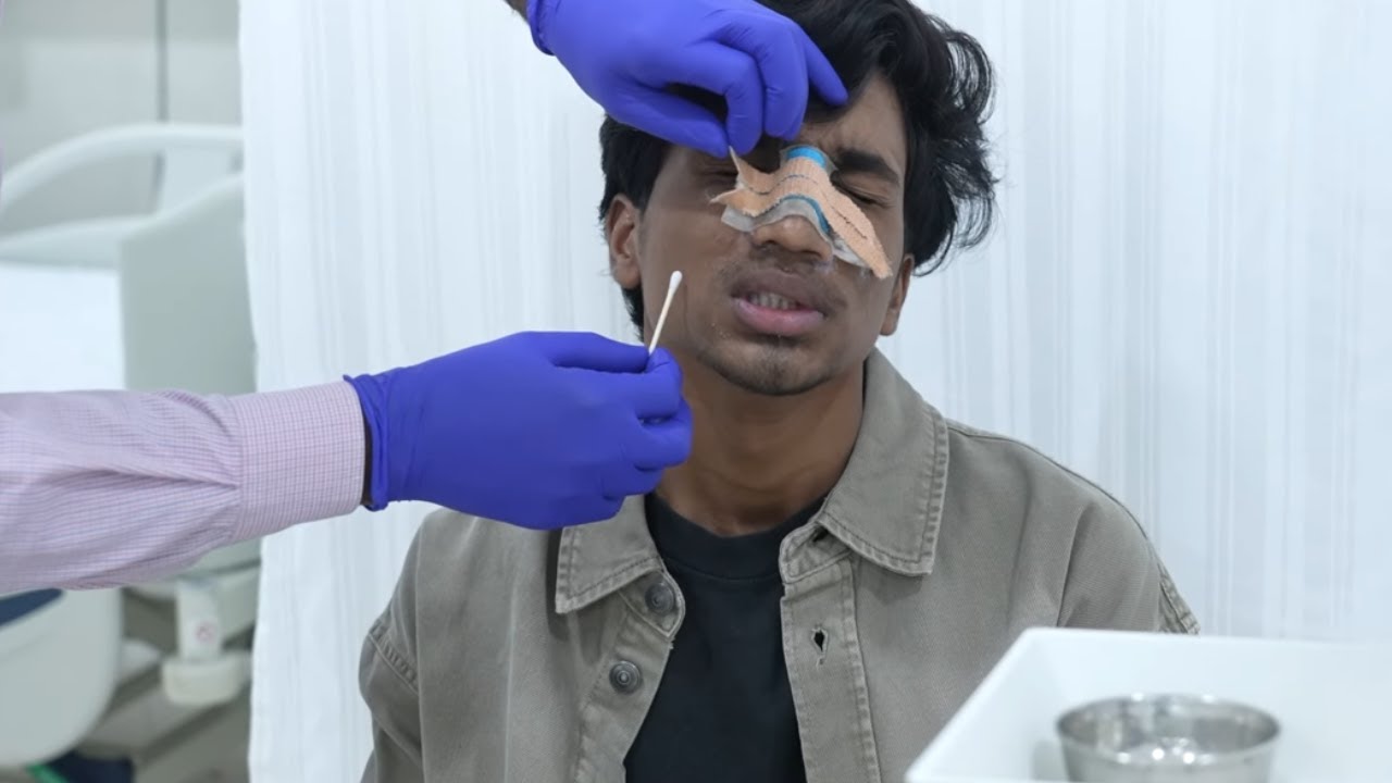 Rhinoplasty Nose Job for a Boy- Before & After - YouTube