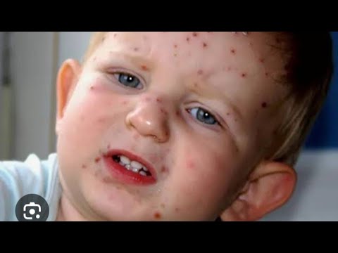 Child got Chicken Pox - YouTube