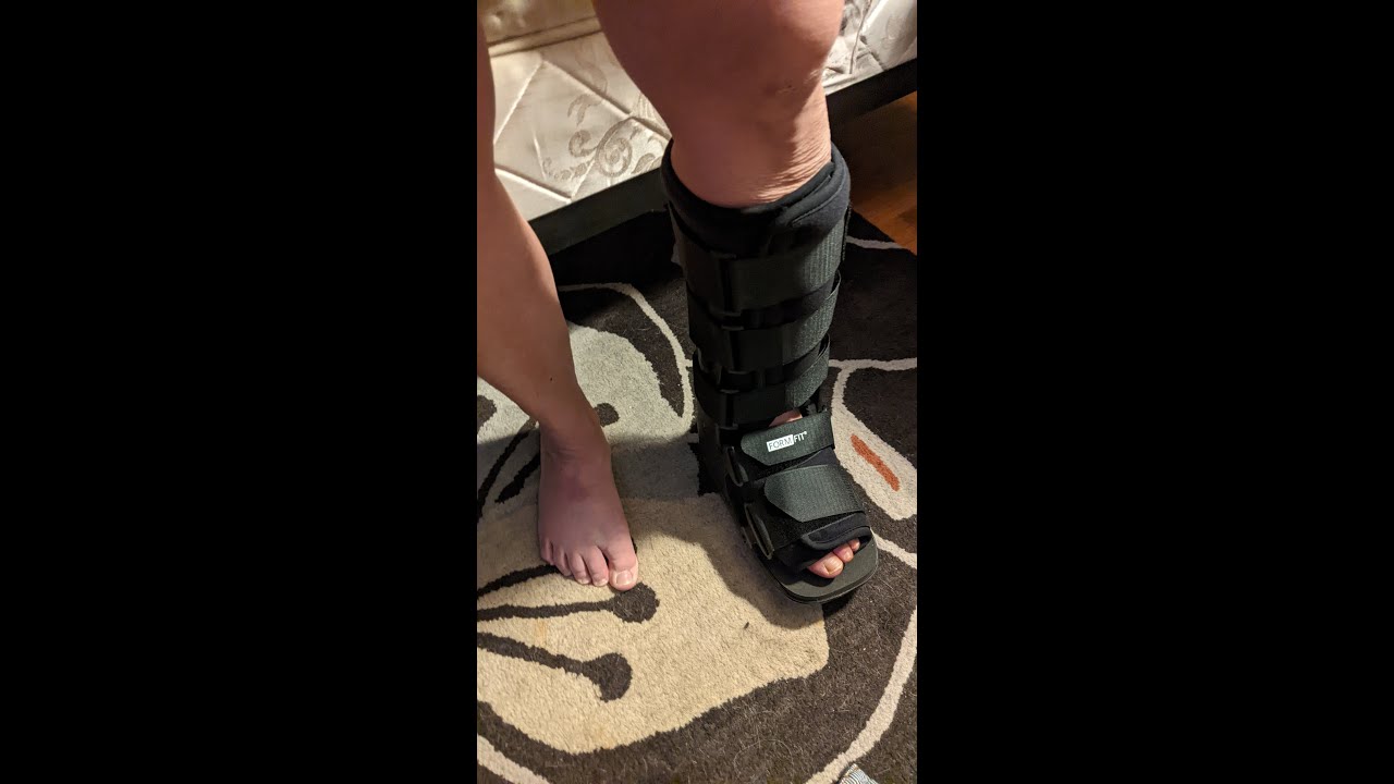Posterior Tibial Tendon Dysfunction Surgery Youtube