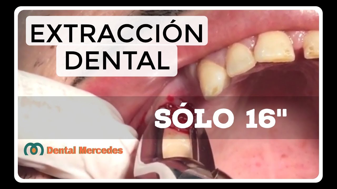 * COMO SACAR RAÍZ DENTAL* Sin tapujos, sólo 16" resto RADICULAR del 15 ...