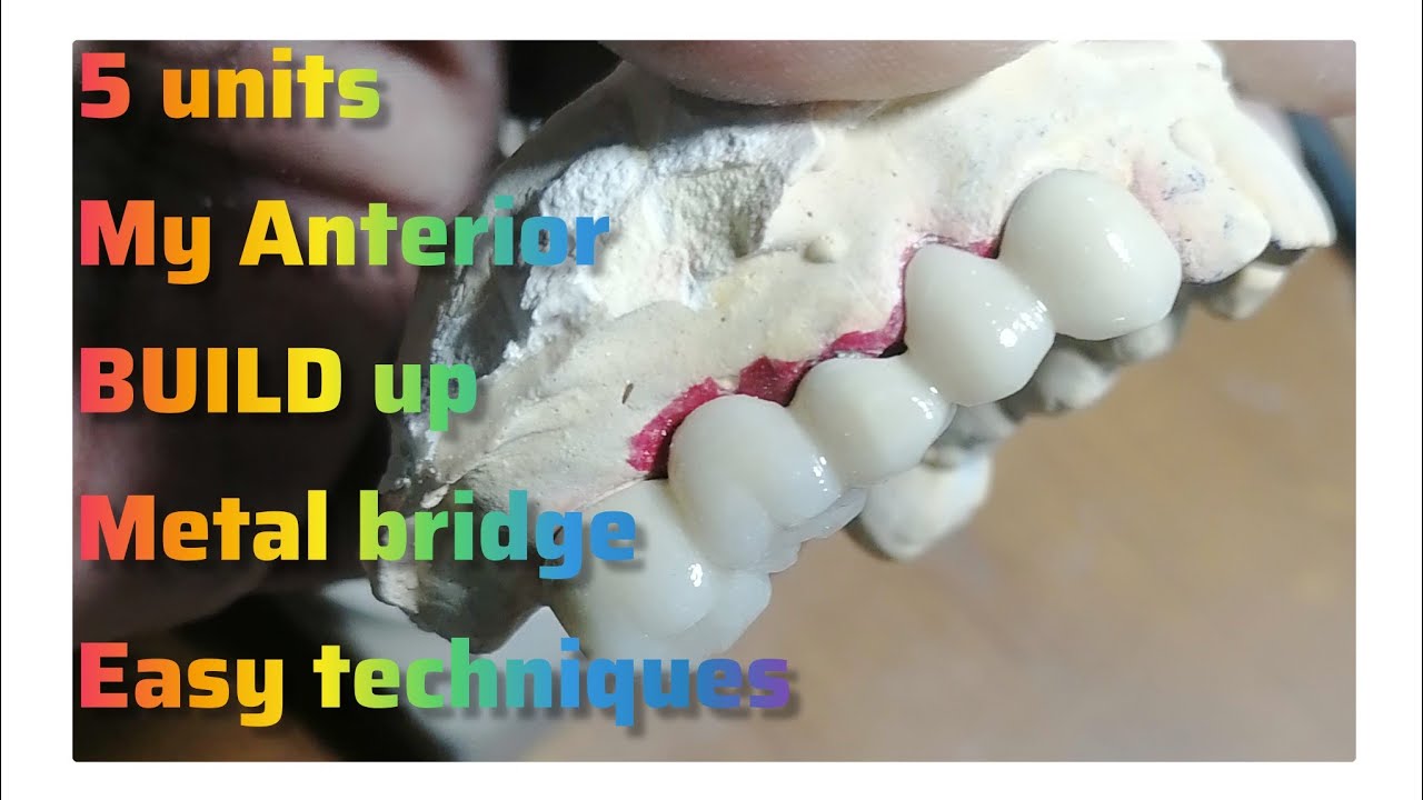 5 units Anterior build up metal bridge easy style - YouTube