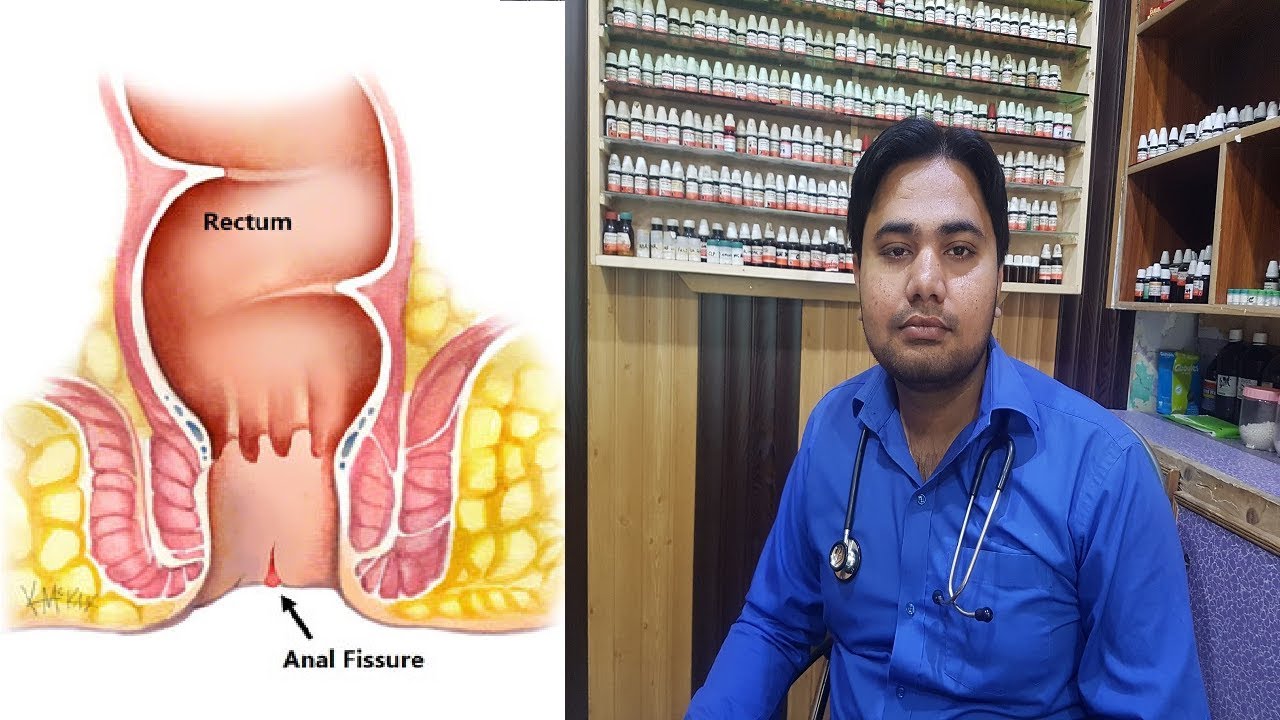 5 Best Homeopathic Medicine For Anal Fissure Anus Fissure Homeopathic