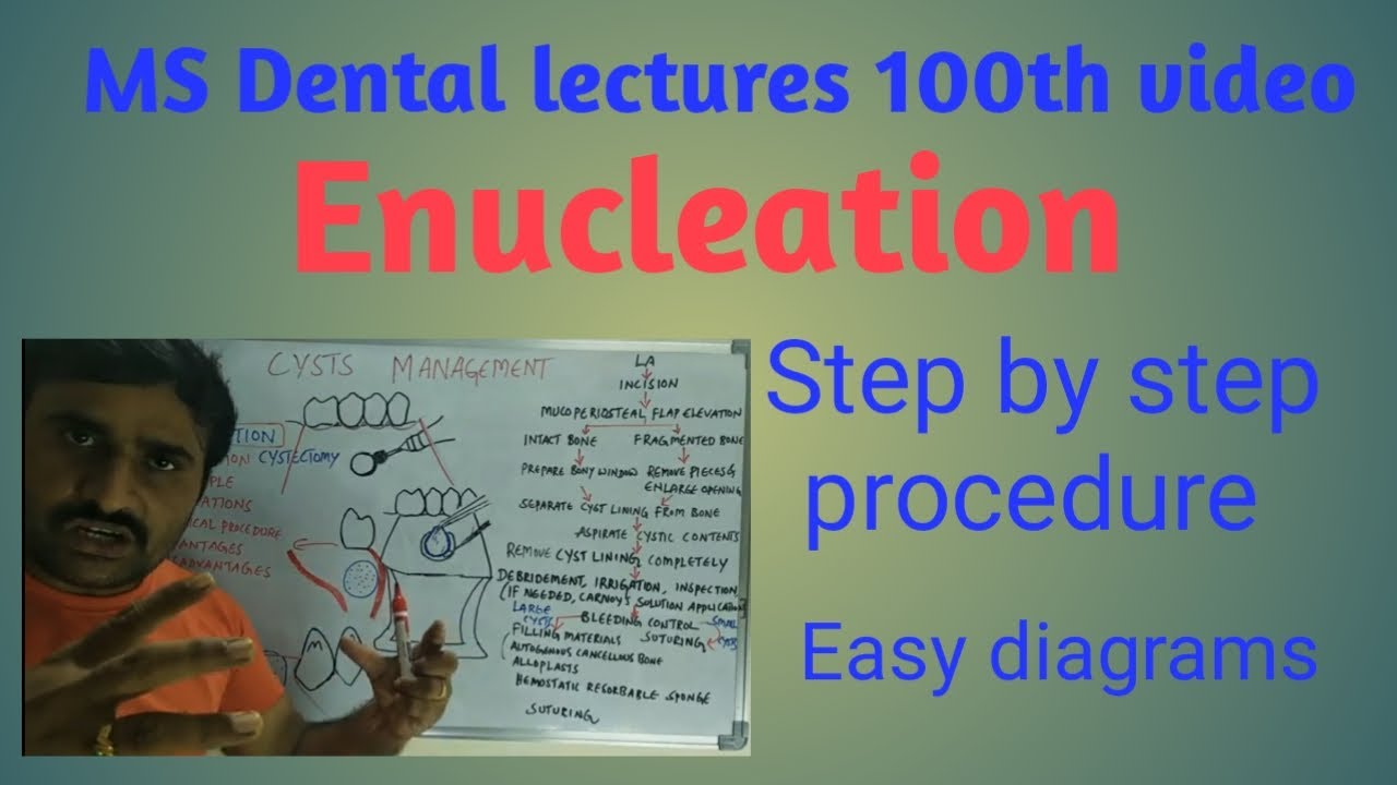 Cyst Enucleation - YouTube
