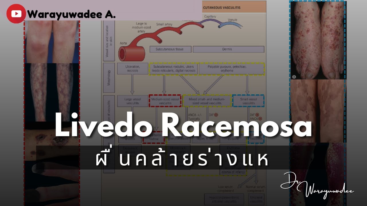 Livedo racemosa ผื่นคล้ายร่างแห | Sep 2023 - YouTube