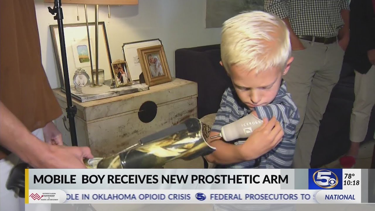 VIDEO: Mobile Boy Receives New Prosthetic Arm - YouTube