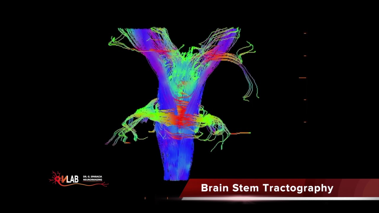 Brain Stem Tractography - 3T MR - YouTube