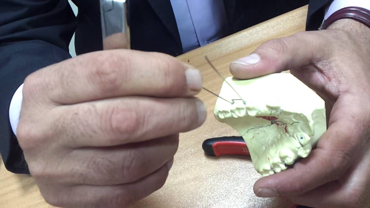 Orthodontics Lab Wire Bending1 Adam s Clasp YouTube orthodontics-lab-wire-bending1-adam-s-clasp-youtube