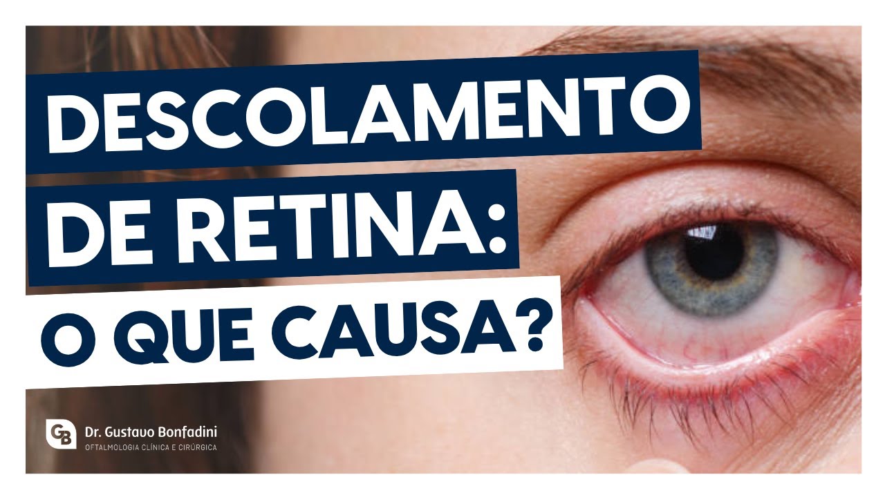 DESCOLAMENTO DE RETINA: O QUE É, CAUSAS, SINTOMAS E TRATAMENTOS - YouTube