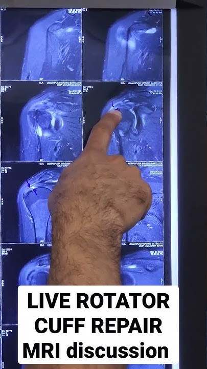 Live Rotator cuff repair. MRI Discussion - YouTube
