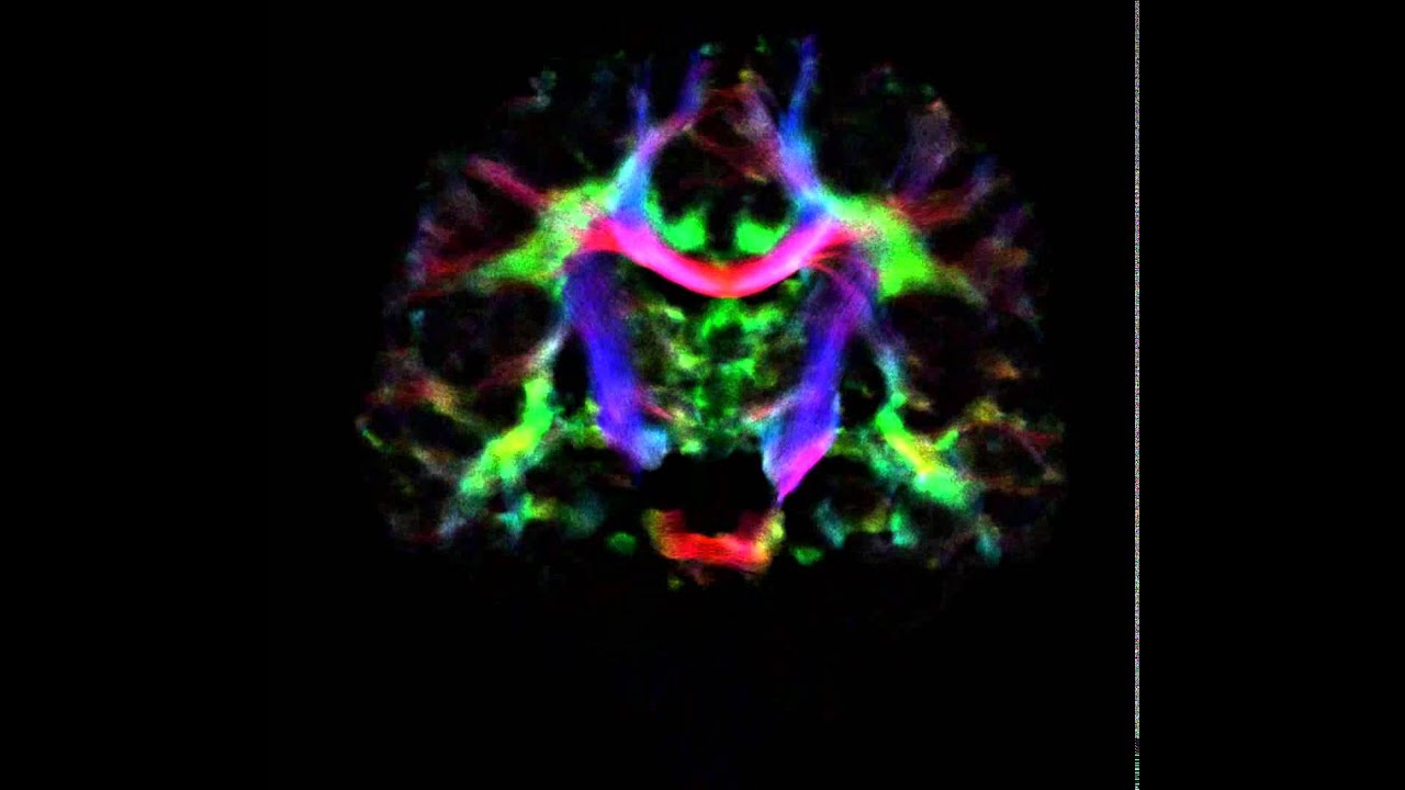 Mapping the Human Brain with Super-Resolution MRI (Coronal View) - YouTube