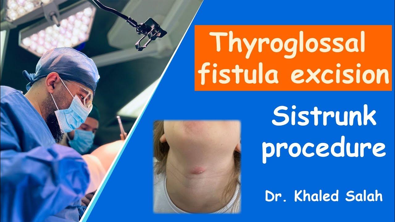 Thyroglossal fistula excision | Sistrunk procedure | ناسور درقي لساني | Khaled Salah - YouTube