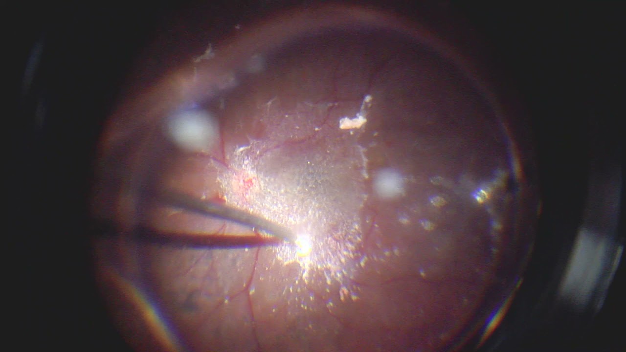 Extendible diamond dusted sweeper 25G (1290.EXS25) - YouTube