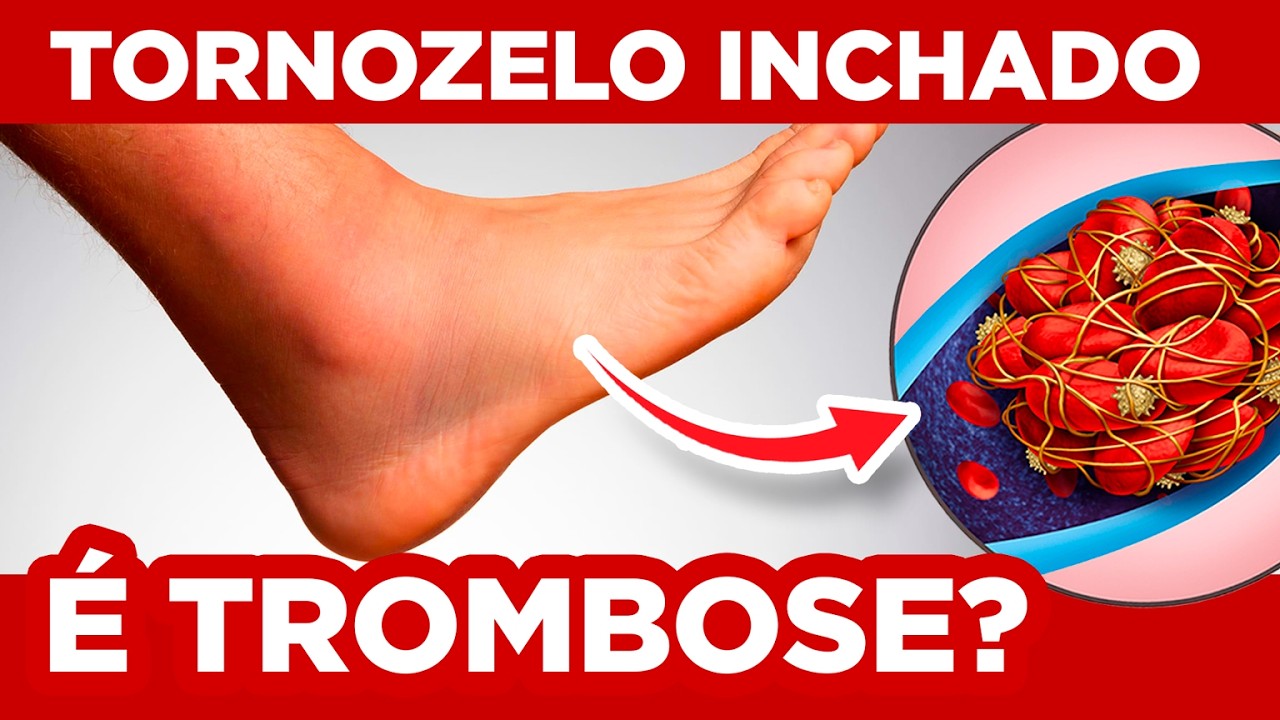 Perna inchada é má circulação e trombose? Tem risco de embolia ou é ...