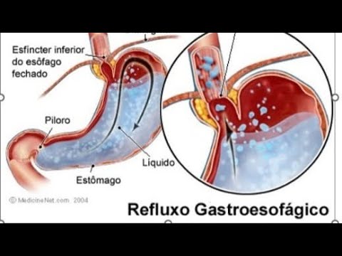 GASTRITE E DOENÇA DO REFLUXO GASTRO ESOFÁGICO - YouTube